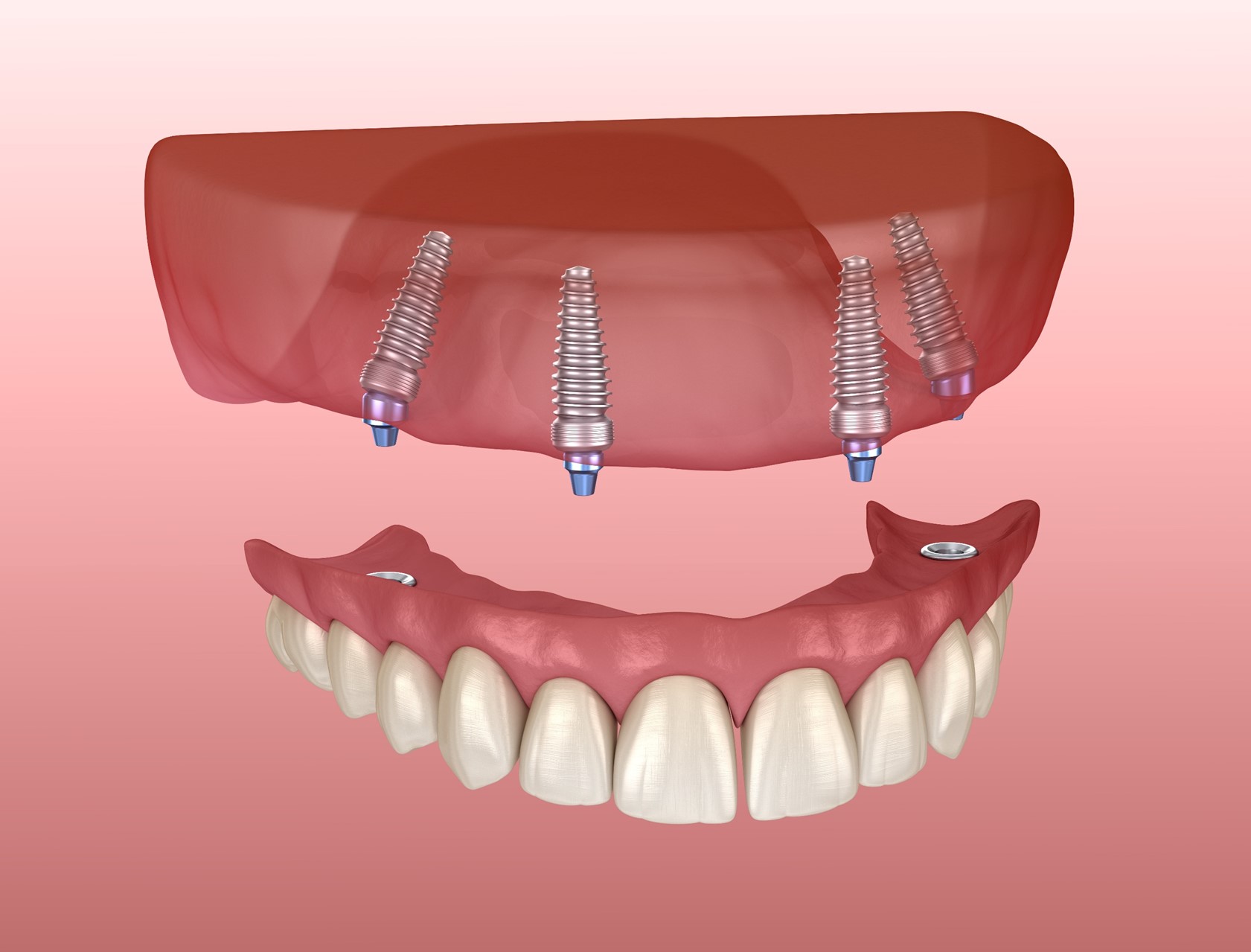 What To Expect After All On 4 Surgery what-to-expect-after-all-on-4-surgery